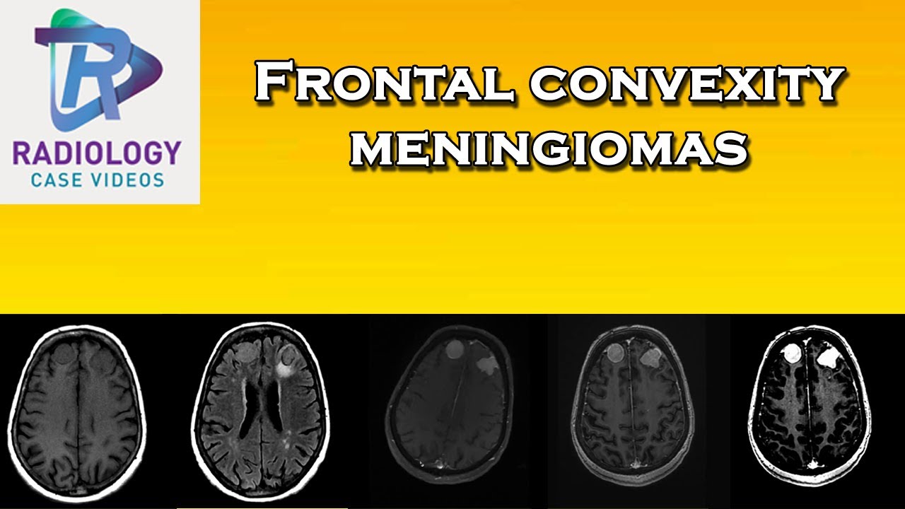 Frontal convexity meningiomas - YouTube
