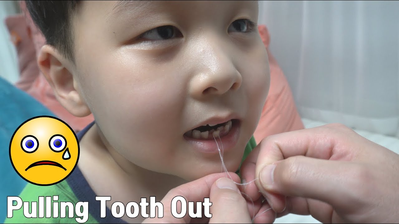 Try pulling tooth out at home. 집에서 실로 이 뽑기에 도전한 호형이. - YouTube