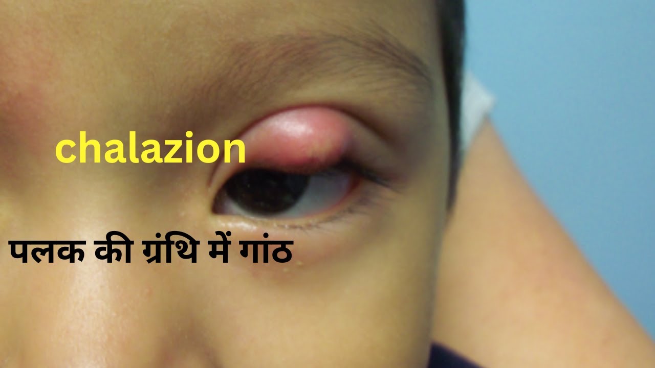 CHALAZION # पलक की ग्रंथि में गांठ #facts - YouTube