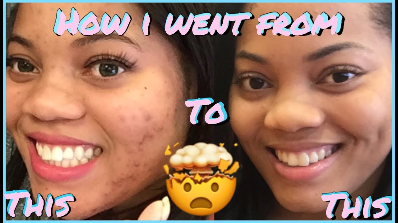 How I Cleared My Skin ☺️ Youtube