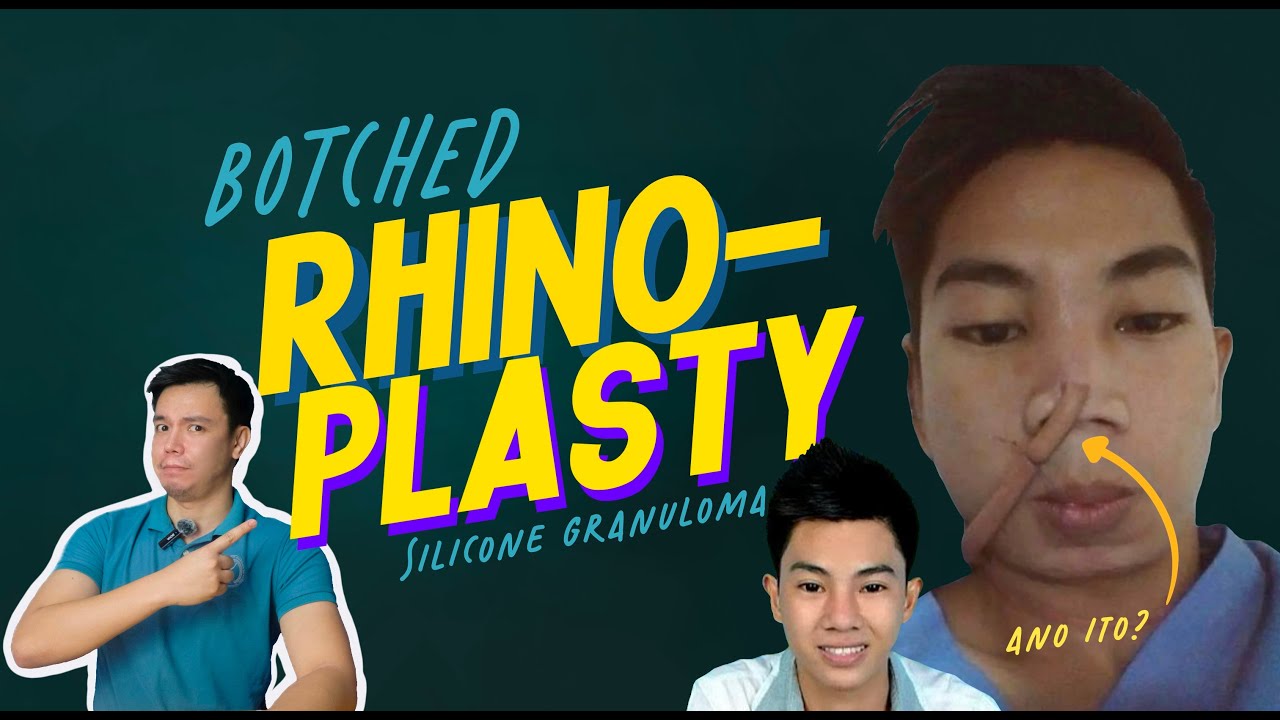 BAKIT MAY NAKALAWIT SA ILONG NI ELLOWE ALVISO? - YouTube