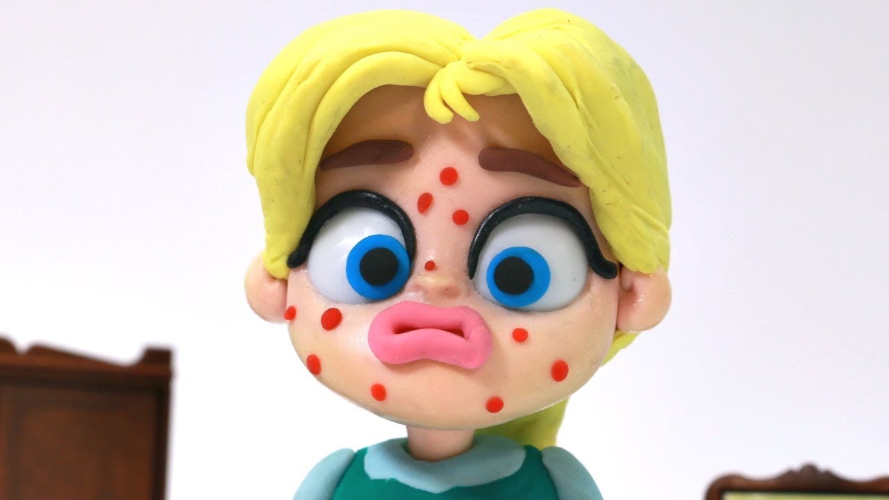 Nasty Pimple Zit Queen Elsa Disney Frozen Movie Episodes 💝 Play Doh ...