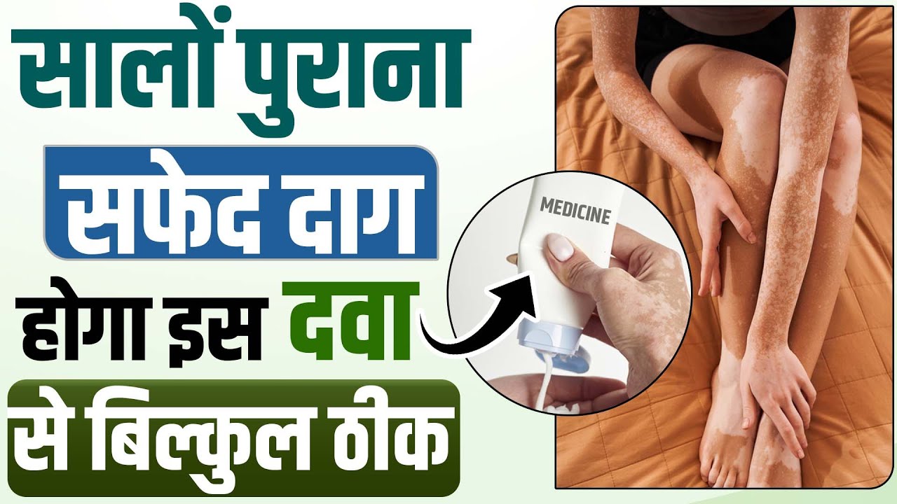 पुराने से पुराना सफेद दाग होगा जड़ से ठीक | Safed Daag Ki Dava | Best ...