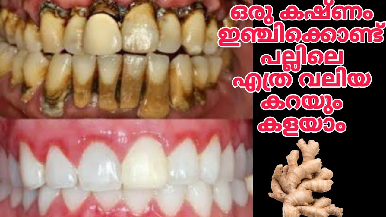 പല്ലിലെ എത്ര വലിയ കറയും കളയാം ഒരു കഷ്ണം ഇഞ്ചി മതി ഒരൊറ്റ ദിവസം കൊണ്ട് ...