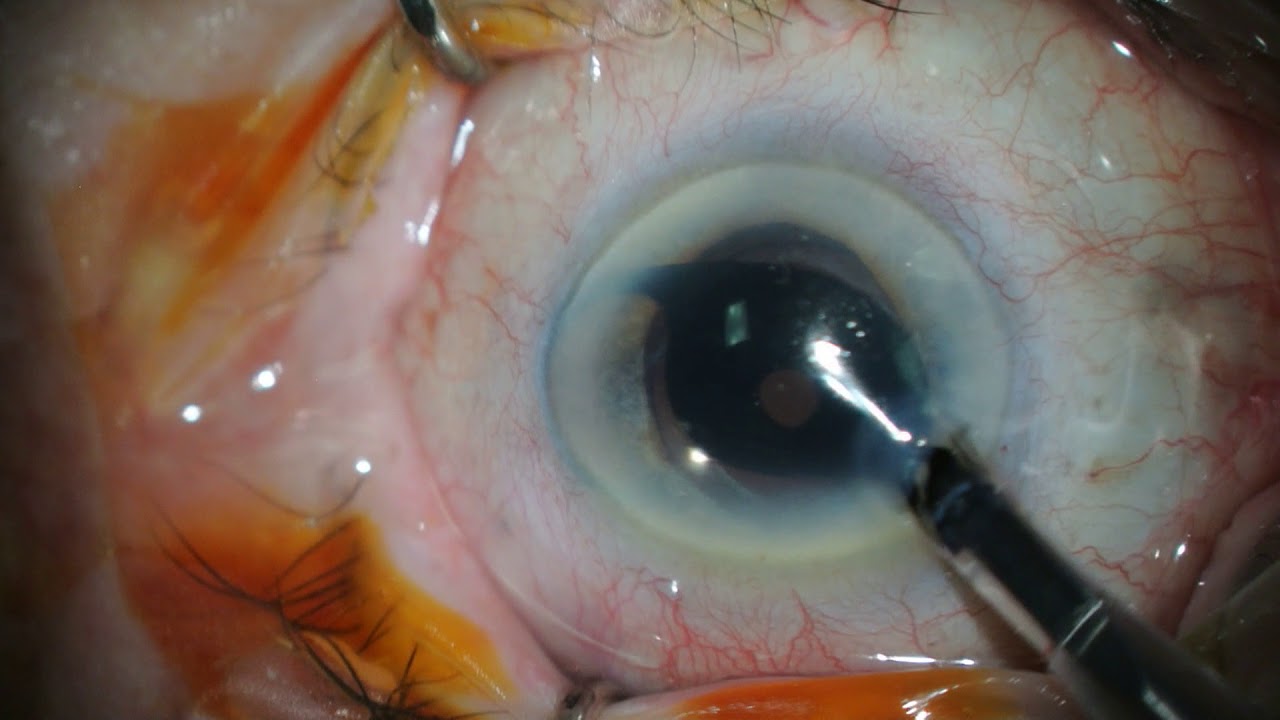 XtraFocus IOL implantation - YouTube