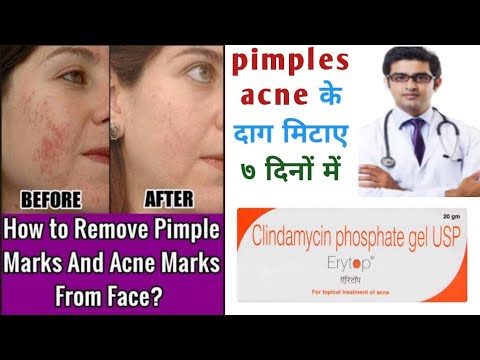 Erytop Cream For Acne n Pimple Skin | The Product Changed My Skin ...