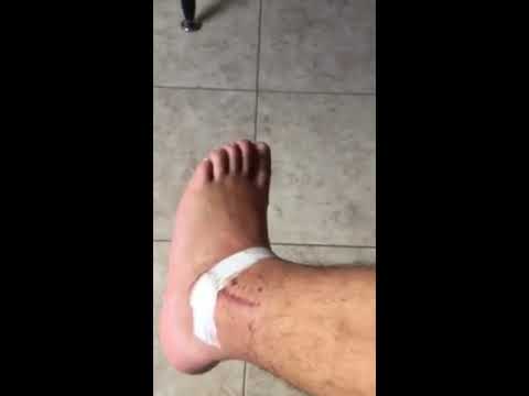 Fractura de tobillo con cirugía volver a caminar . Primeros días ...