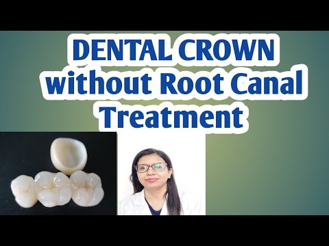 IS DENTAL CROWN without Root Canal possible? - YouTube