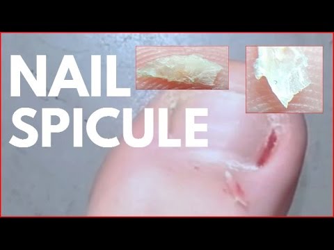 Nail Spike. Nail Spicule. Espicula ungueal. - YouTube