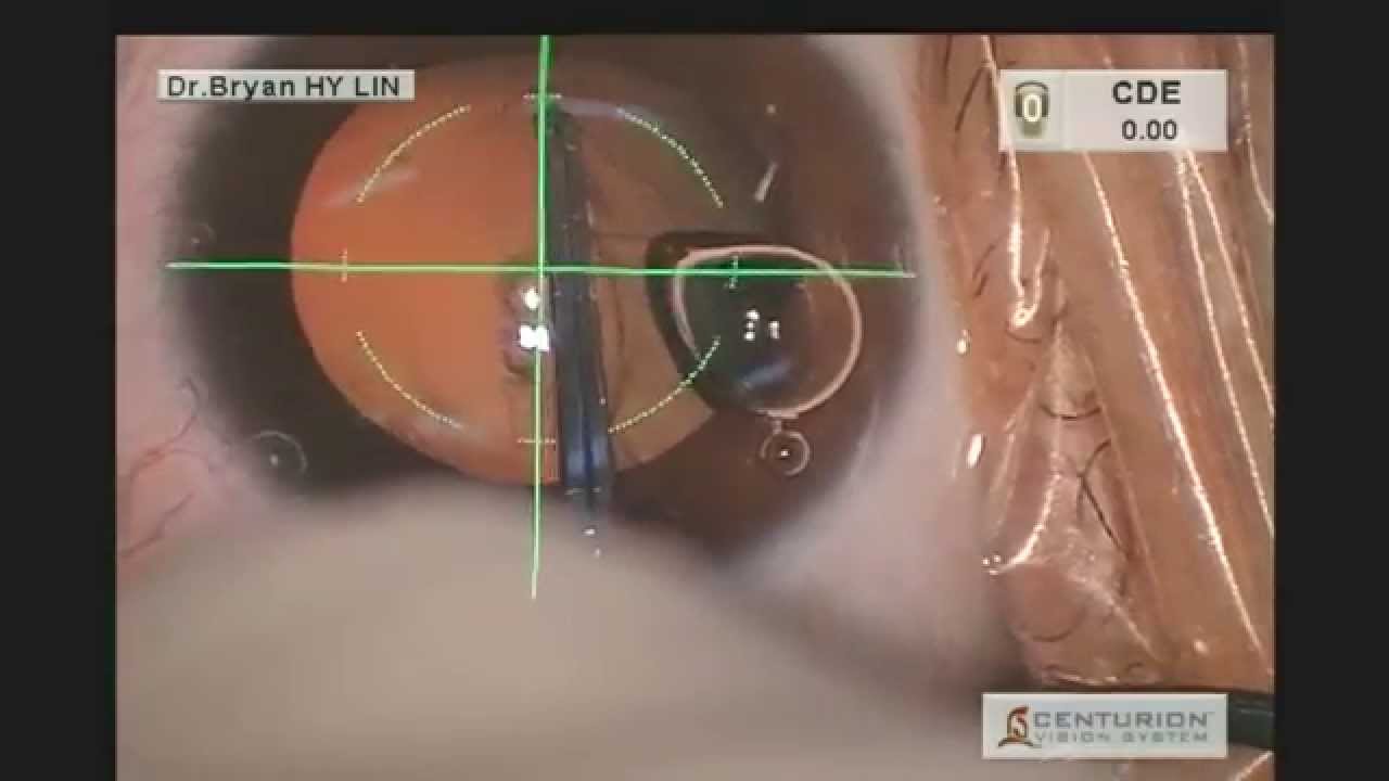 Cataract Surgery: Use Verion system to make a good CCC - YouTube