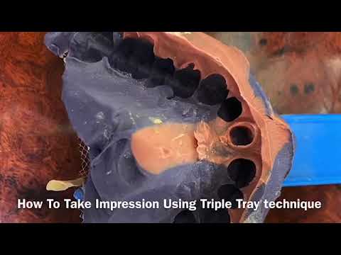 How to take good impression using triple tray technique - YouTube
