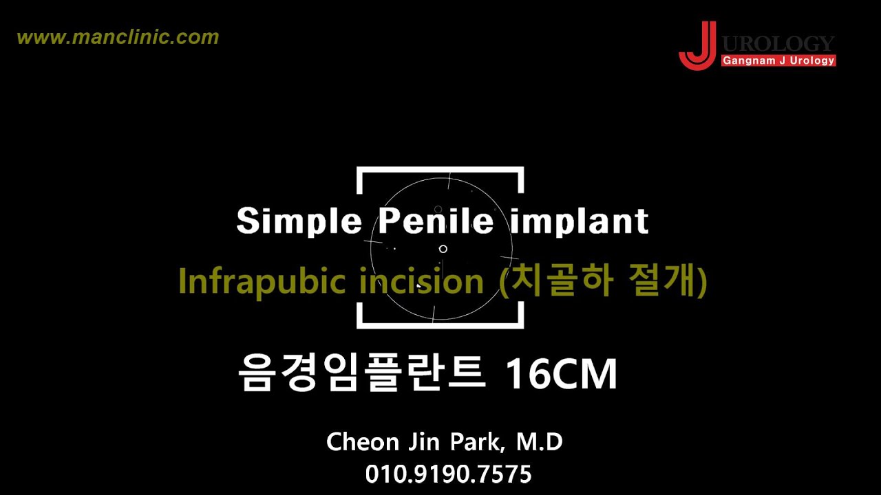 Simple Penile implant Infrapubic incision (치골하 절개) 음경임플란트 16CM - YouTube