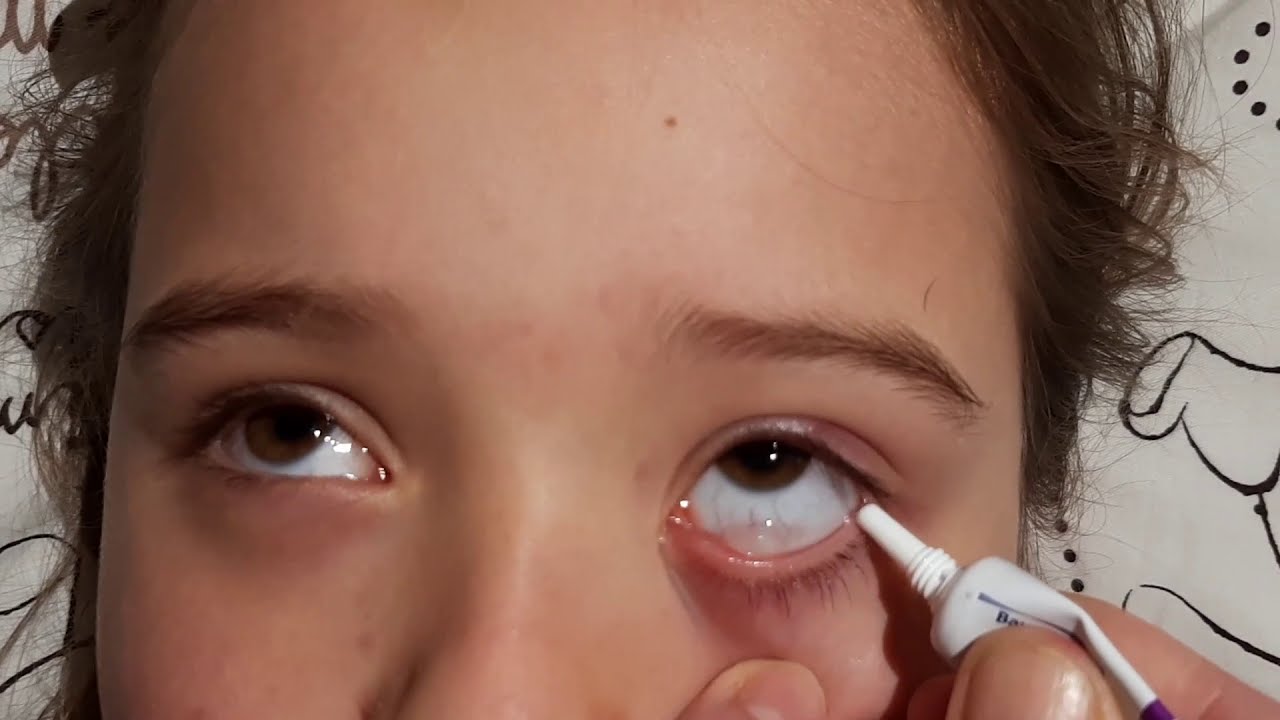 Leczenie gradówki (jęczmienia wewnętrznego) | Chalazion treatment - YouTube