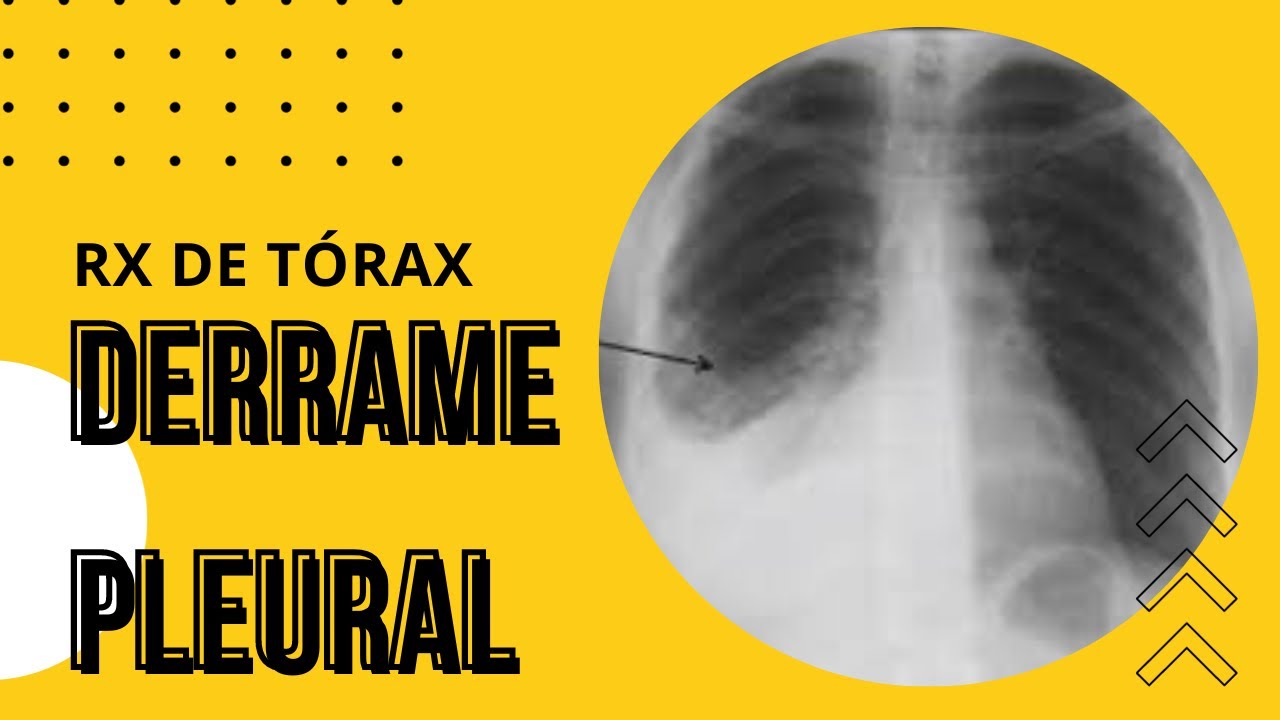 Derrame pleural (radiografía de tórax) - YouTube