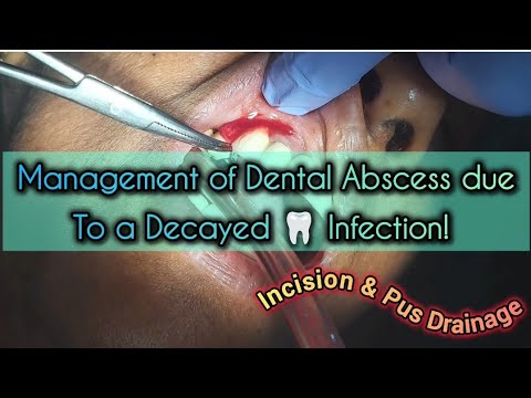 How it's done: Draining Tooth Abscess Involving Canine & Vestibular ...