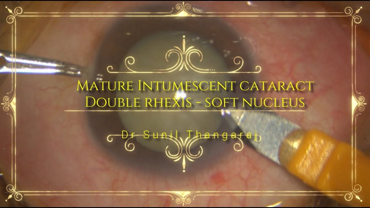 Mature Intumescent Cataract - The double rhexis in safe Phaco ...