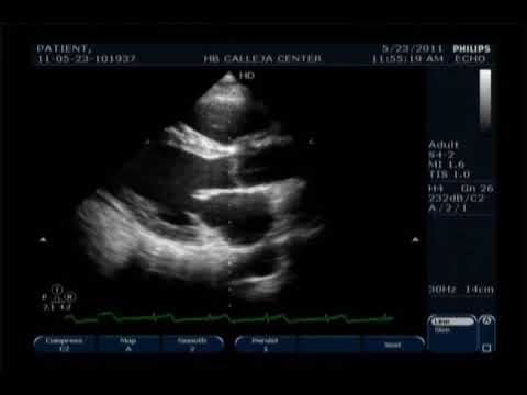 2D Echo M-mode, Color, Doppler | HB Calleja Center - YouTube
