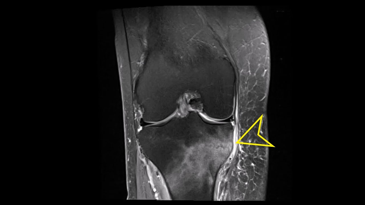 Knee MRI: Tibial Insufficiency Fracture - YouTube