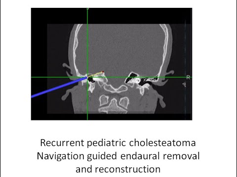 Navigation guided endaural removal of pediatric cholesteatoma - YouTube