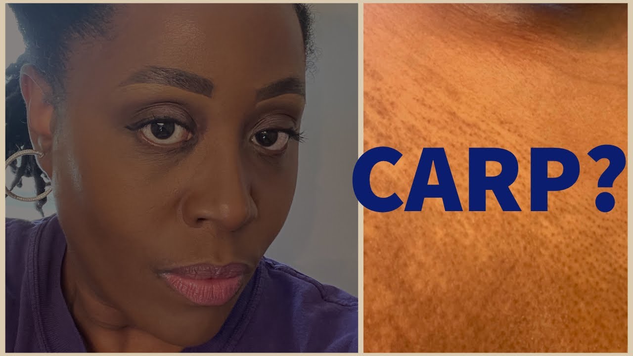 Living with CARP Skin - YouTube