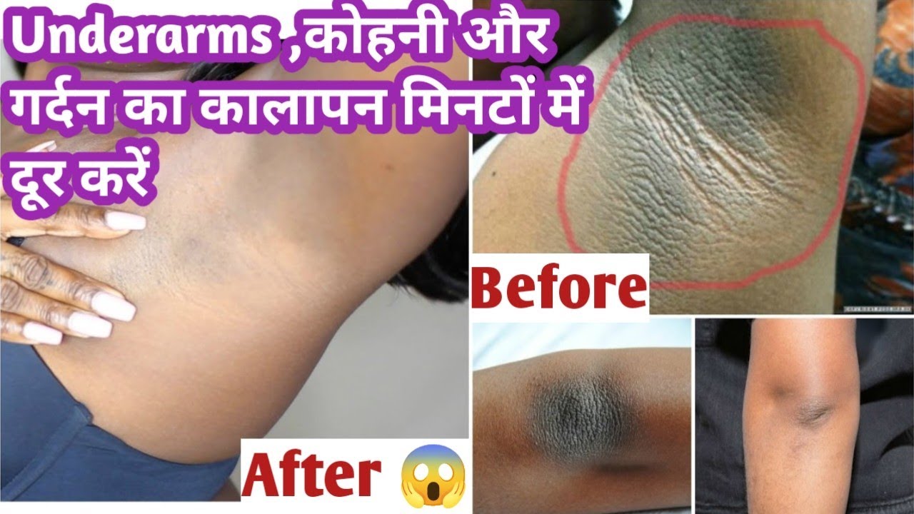 Black underarms ko white kaise kare / black underarms treatment ...