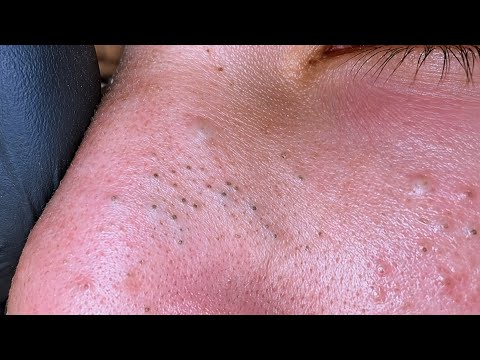 Relaxing [ASMR] Facial Treatment for Blackheads and Pimples