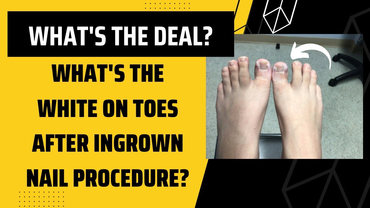 What's the deal? - White on sides of toes after Ingrown nail procedure ...