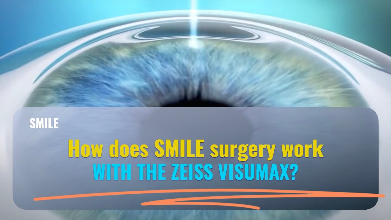 How does SMILE surgery work with the ZEISS VisuMax? - YouTube
