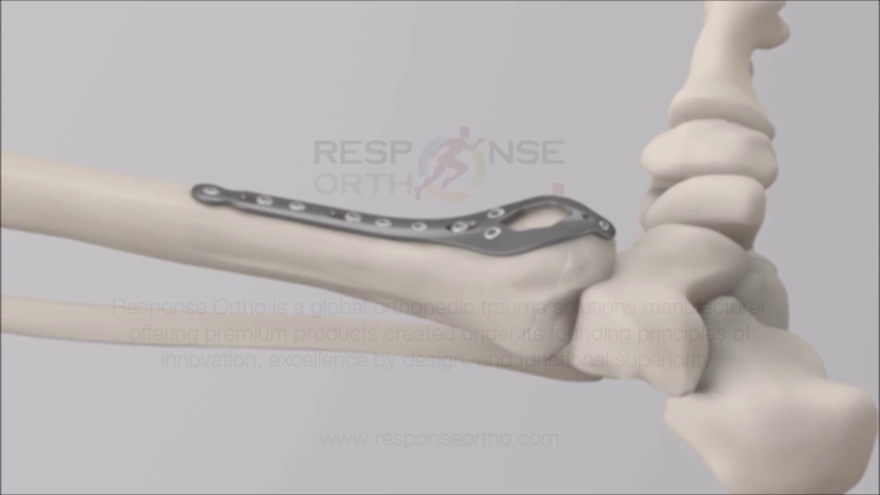 STEP™ Ankle Fracture Plating System - Medial Spoon Plate - YouTube