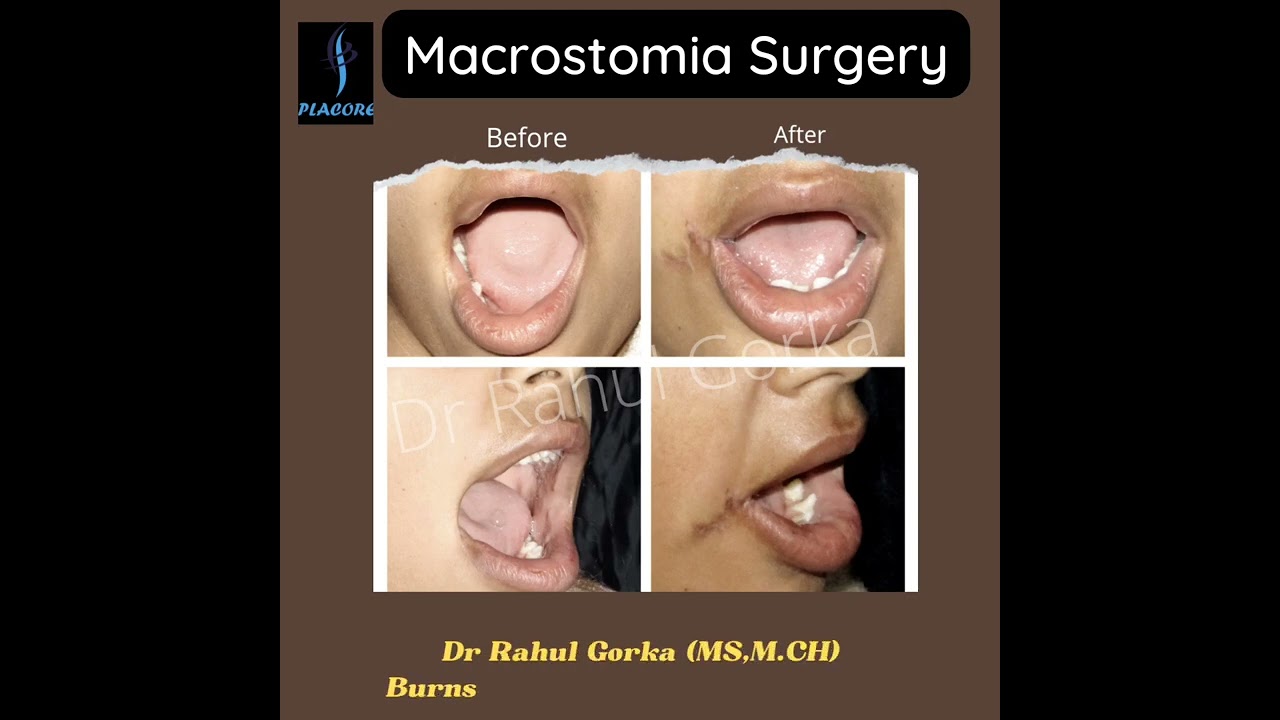 MACROSTOMIA REPAIR #DrRahuGorka #Lip-reconstruction # ...