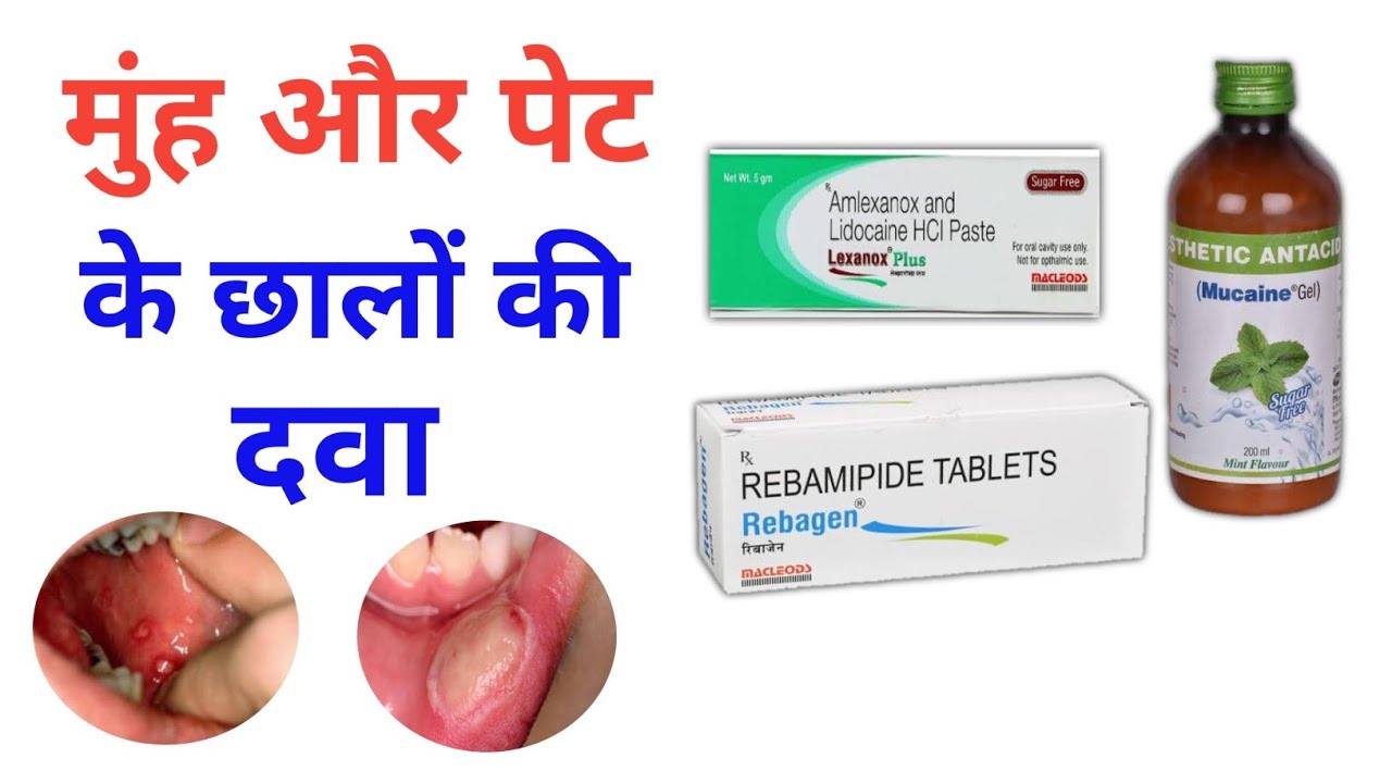 मुंह के छाले और पेट के छालों से पाएं छुटकारा।। rebagen tablet, lexanox ...