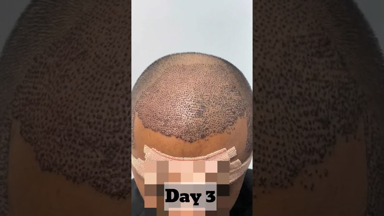 Hair Transplant Days till Scab Removal. How long scabbing is seen ...