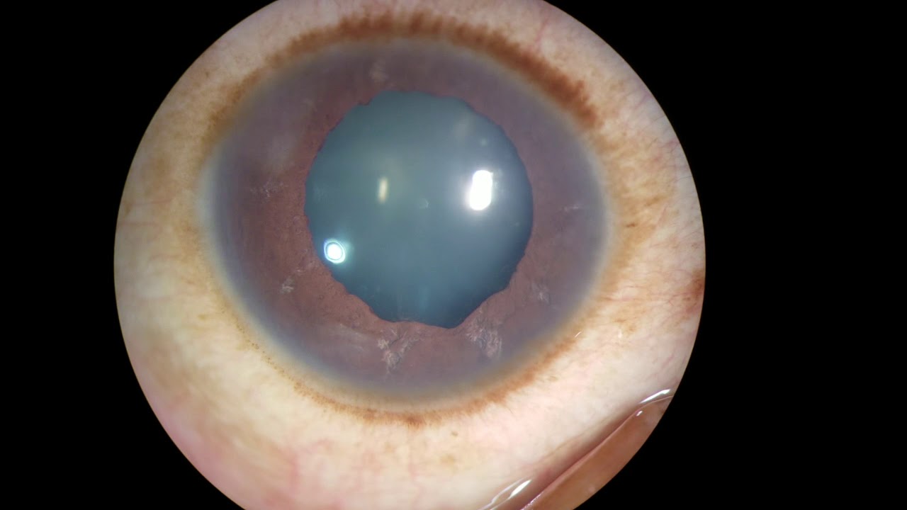 Traumatic cataract with phacodonesis - YouTube