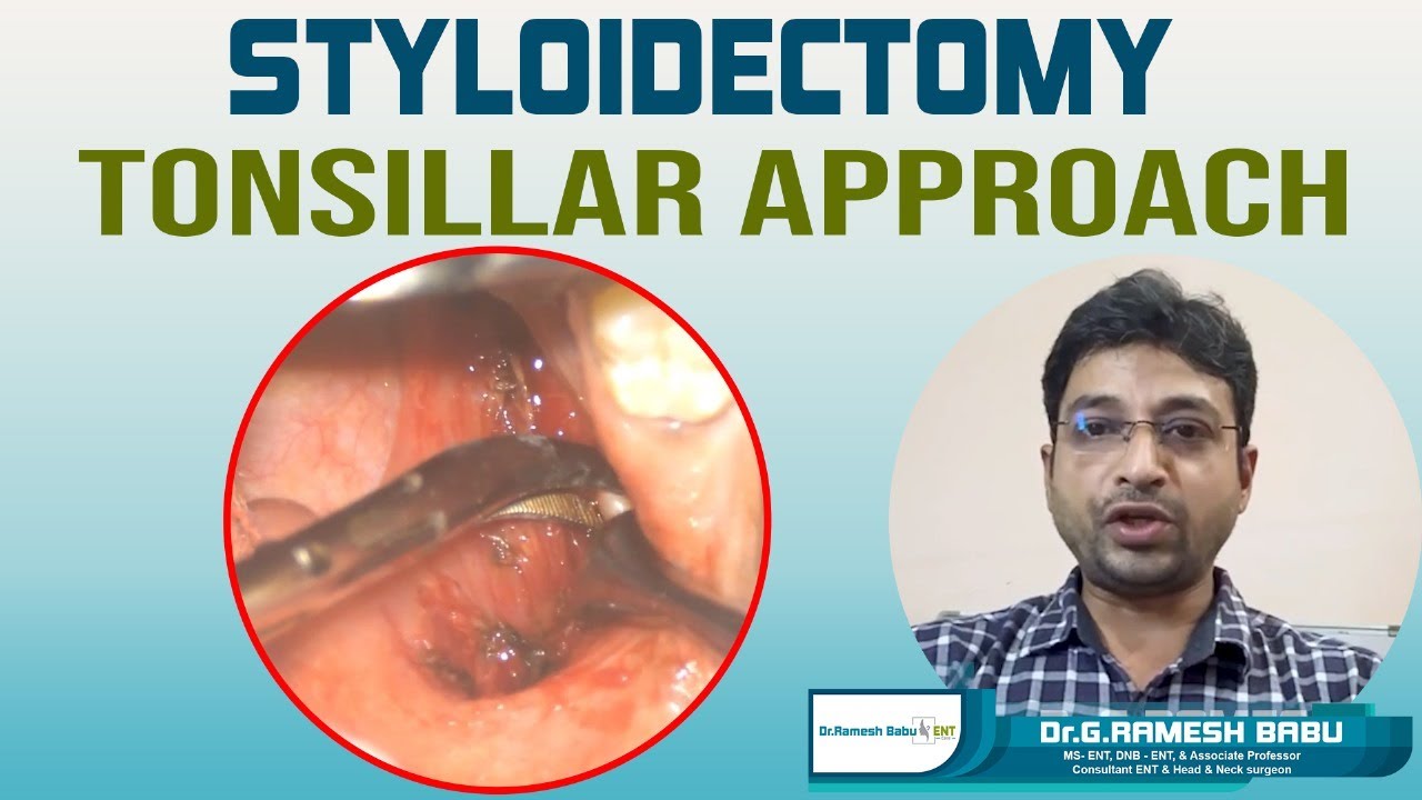 STYLOIDECTOMY - TONSILLAR APPROACH || Dr Ramesh Babu ENT - YouTube
