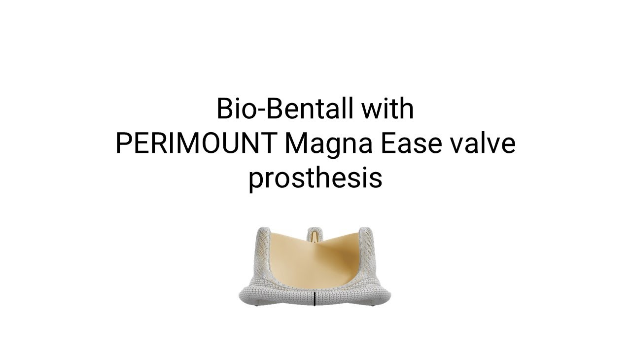 Bio-Bentall with Perimount Magna Ease valve prosthesis Dr Yugal Mishra ...