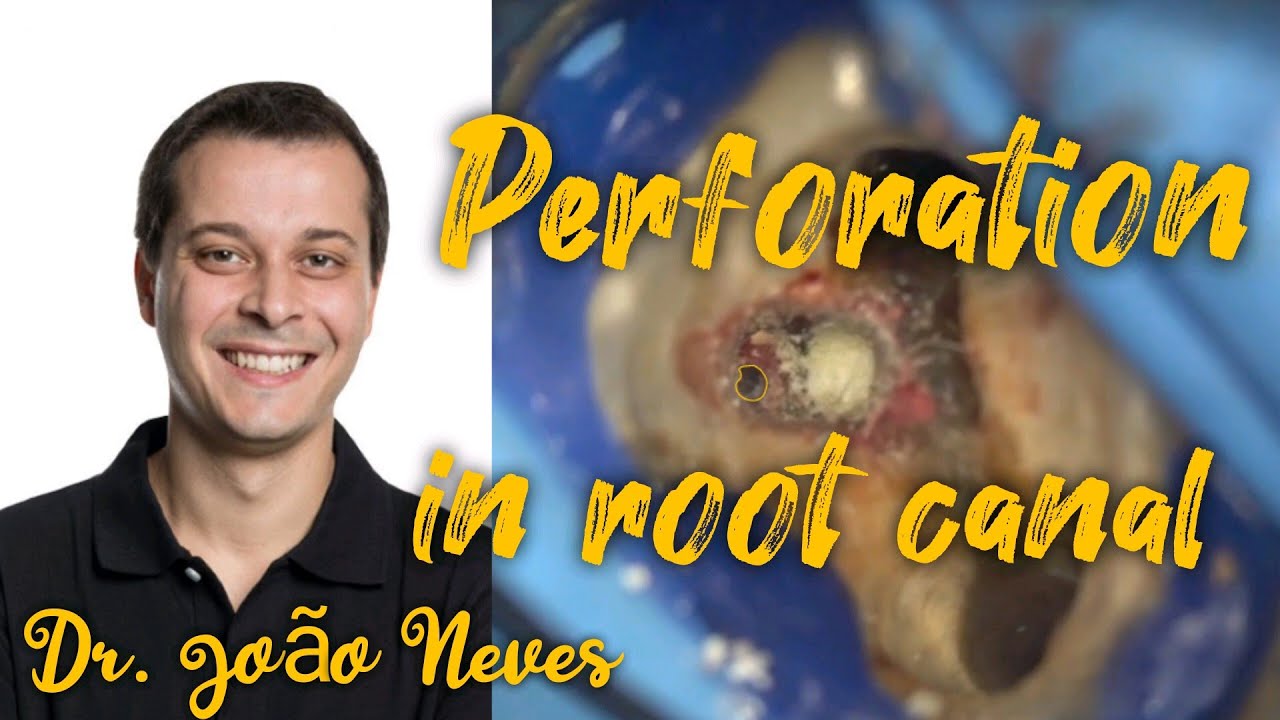 Treatment perforation in root canal. Endodontic retreatment. Dr. João ...