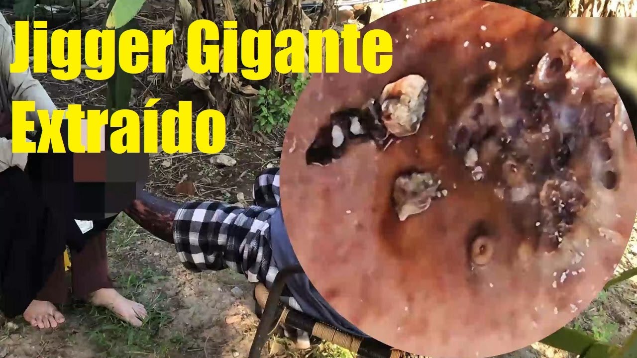 🔴🔥🦶 Shocking Jigger Infection | Foot Recovery Process 242462 - YouTube