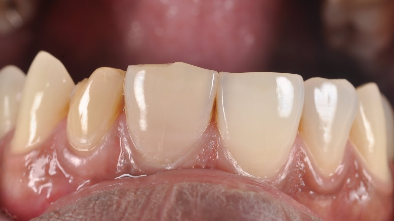 Treatment for dark tooth - the sequel ( step by step internal bleaching ...