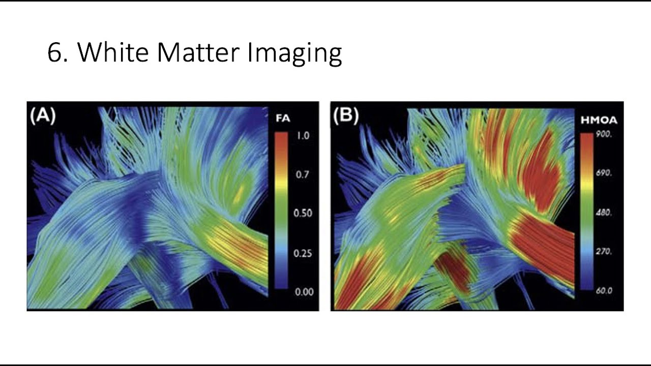 3.6. White Matter Imaging, Fundamentals of Cognitive Neuroscience ...