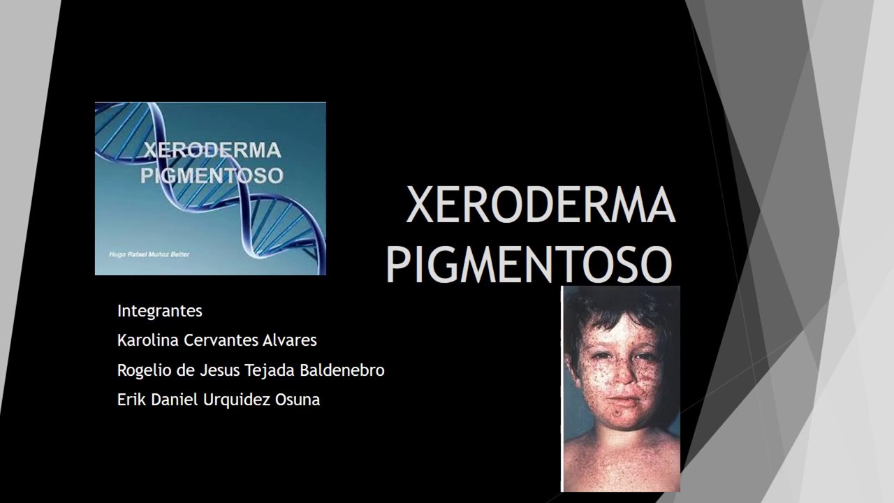Xeroderma Pigmentoso - YouTube