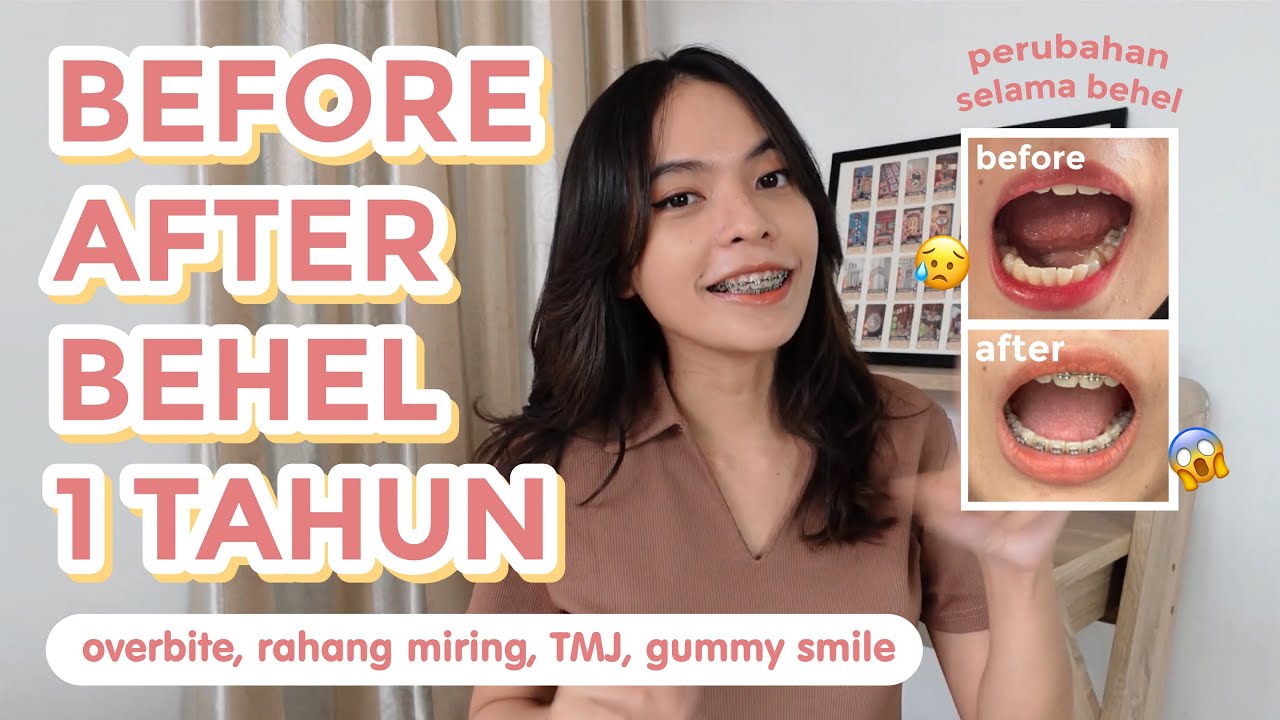 BEFORE AFTER BEHEL 1 TAHUN - banyak banget perubahannya!! | Braces ...