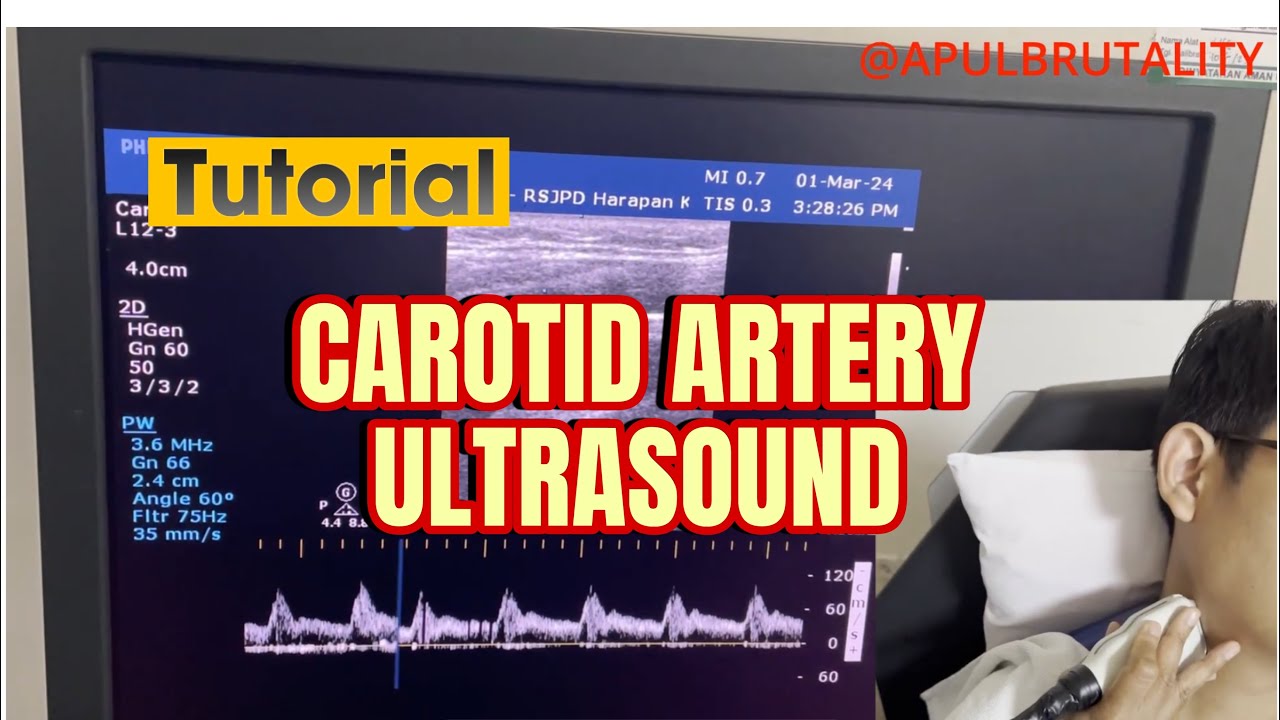 Carotid ultrasound - tutorial - doppler ultrasound (DUS) - YouTube