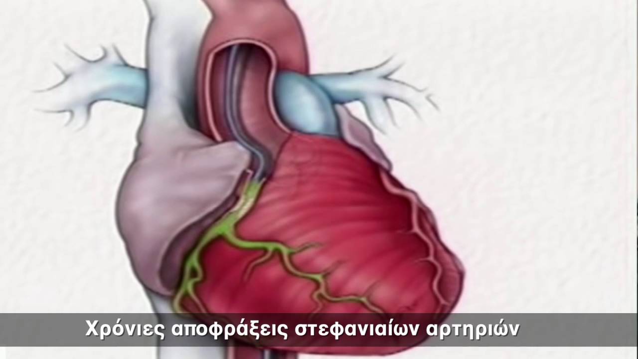Χρόνιες αποφράξεις στεφανιαίων αρτηριών - YouTube