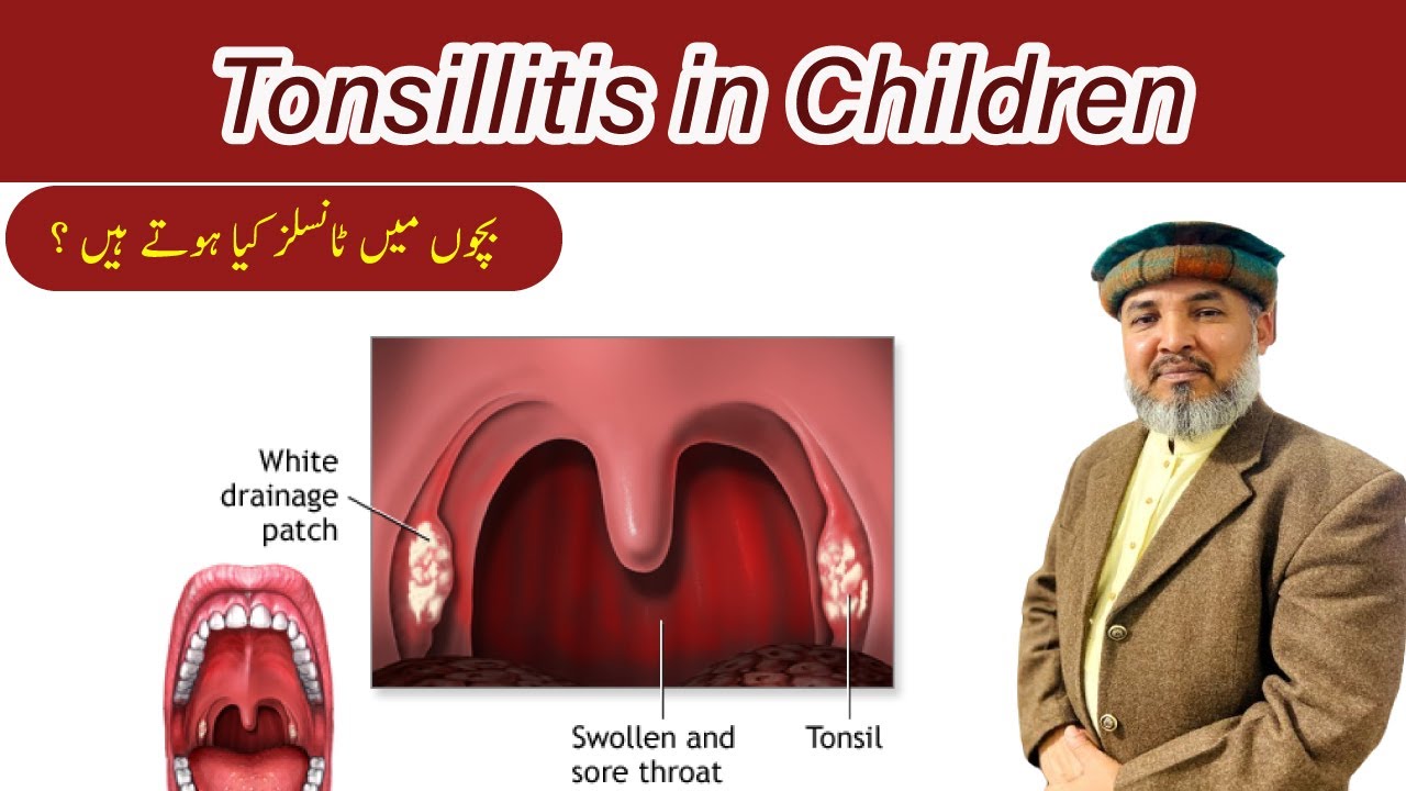 Tonsillitis in Children | Gale Ke Tonsil Ka ilaj | Tonsils Ka ilaj ...