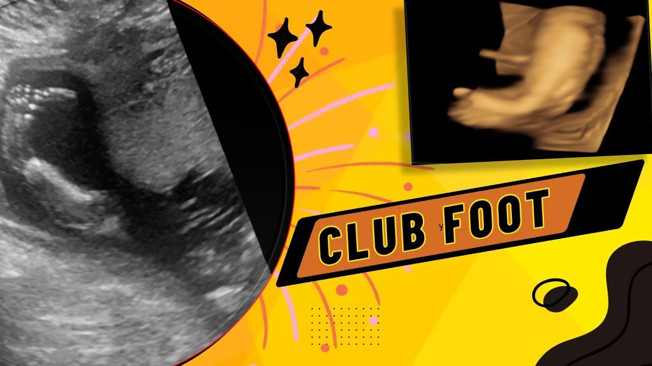 Talipes Equinovarus / Club Foot : Causes, Symptoms, Diagnosis and ...