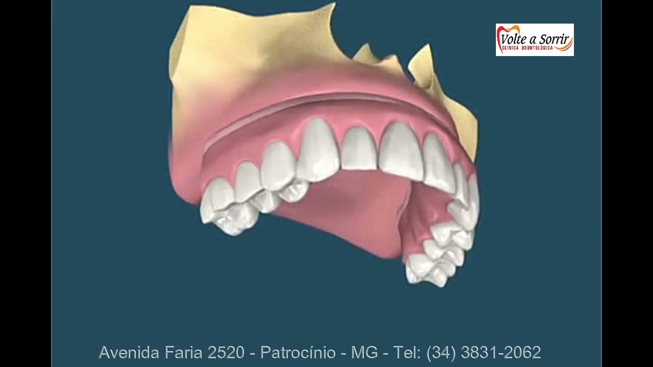 Prótese Protocolo Superior - YouTube