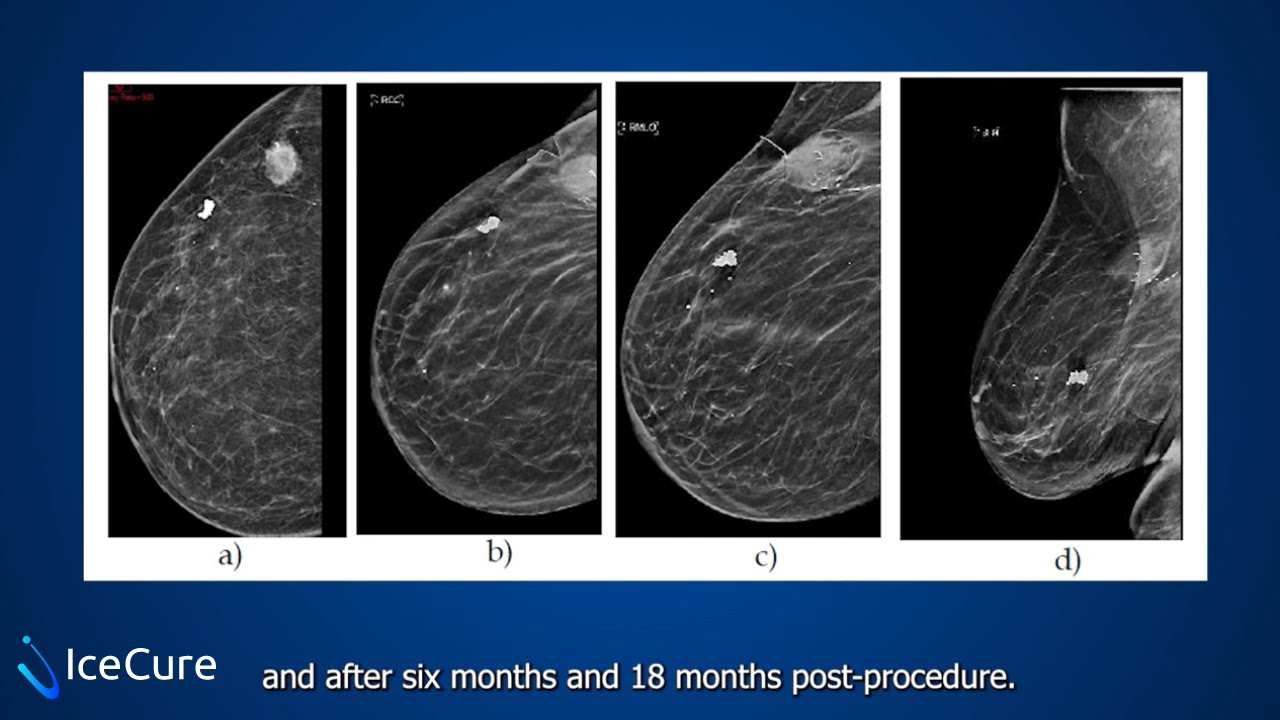 Minimally Invasive Treatments: Dr. Noa Rotbart Discusses Cryoablation ...