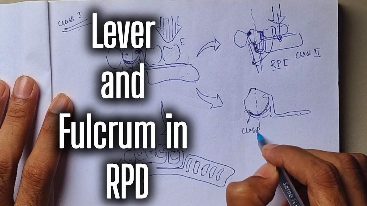 Lever & Fulcrum in RPD Made EASY 🔥 | Class I → Class II Concept ...