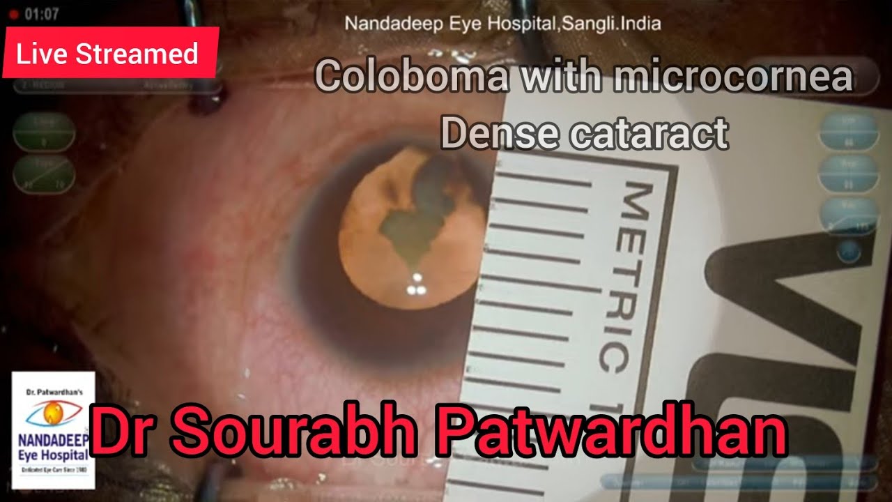 coloboma with microcornea Dense cataract Dr Sourabh Patwardhan Live ...