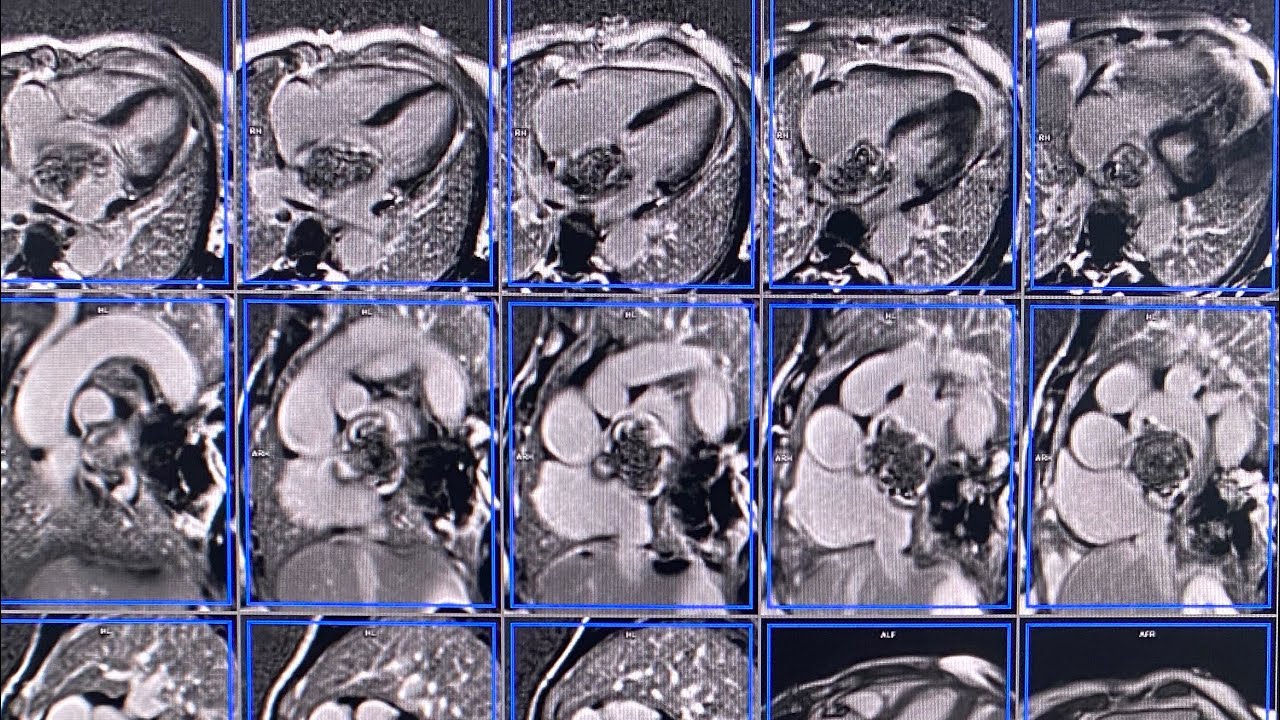 Cardiac MRI With Contrast sequence ( High Resolution SHAX & Axial) Left ...